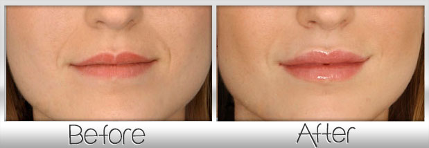 Perlane Lips Before And After | Lipstutorial.org